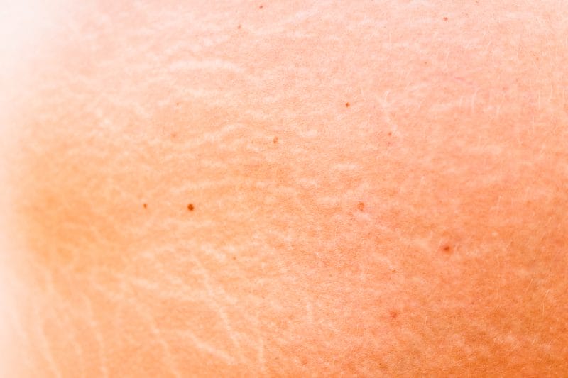 Understanding Orange Peel Skin: Causes and Solutions - Aesthetics Unique